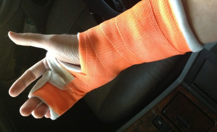 The Most Expensive Bone Fractures To Treat